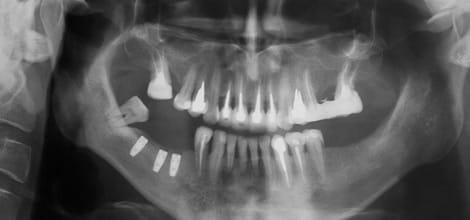 Fixed versus removable appliances - The DDU